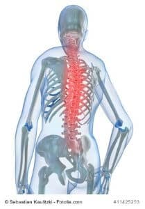 Morbus Scheuermann – Ursachen, Symptome und Therapie