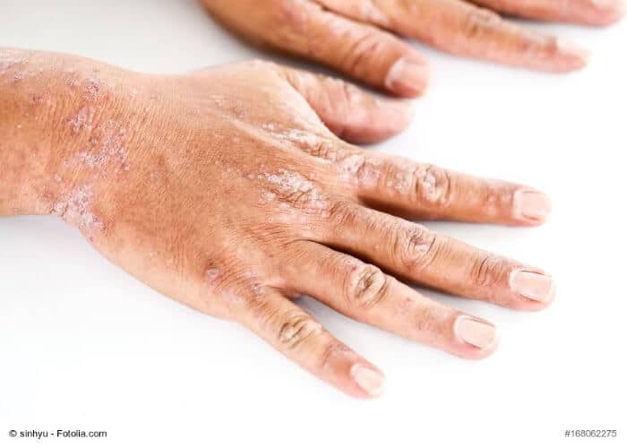 Dyshidrosis – Ursachen, Symptome und Therapie
